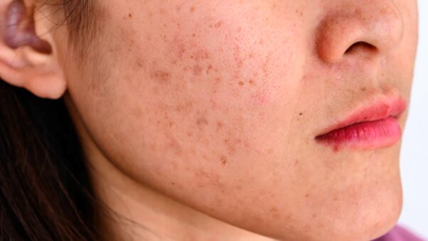 What Dermatologists Really Think About CLASCON® (WINLEVI): The Acne ...